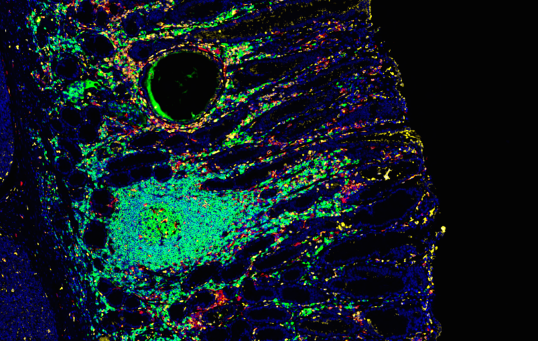 Inflammation and stomach cancer: the H. pylori connection
